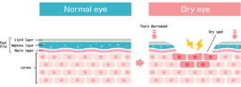 Dry Eye Services Portsmouth | Dry Eye Syndrome Exeter, NH